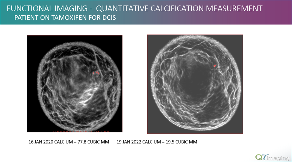 Breast Imaging Options — A Patient Advocate Investigates ABUS and QT ...